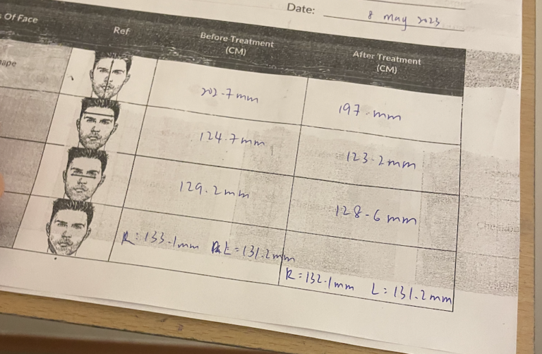 Kogao, Japanese Small Face Correction Facial Therapy at Ikeda Spa ...